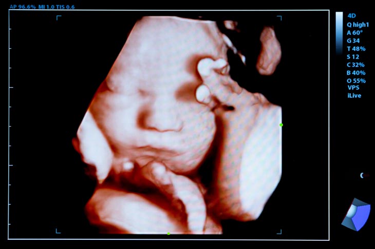 3D Ultrasound Wide Nose - Why Is It The Case?