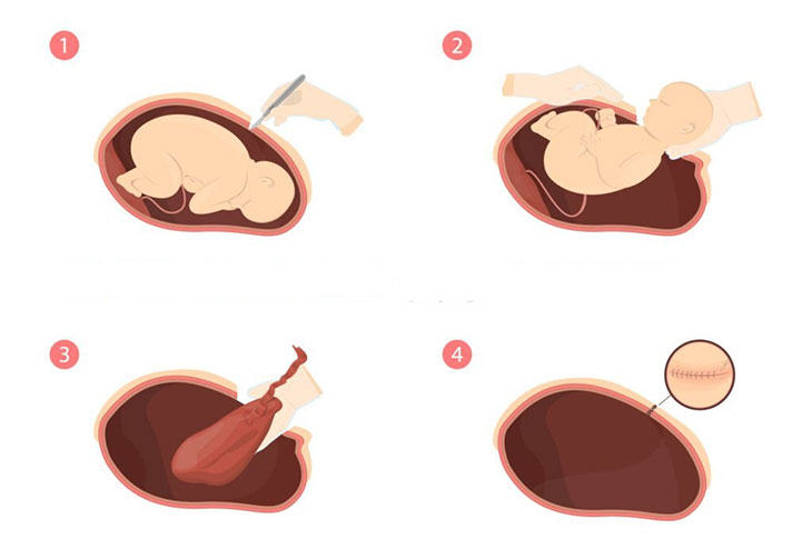How Long Labor After Induction? Does Induction Always Work?