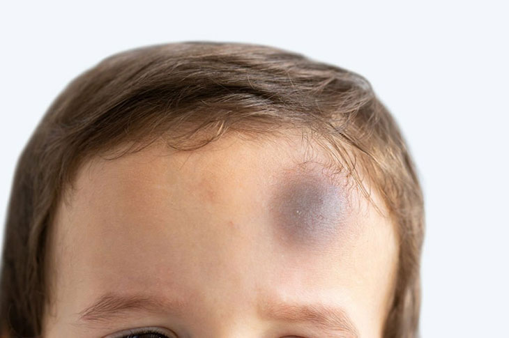 Baby Fell And Hit Head On Hardwood Floor: Problem Solved